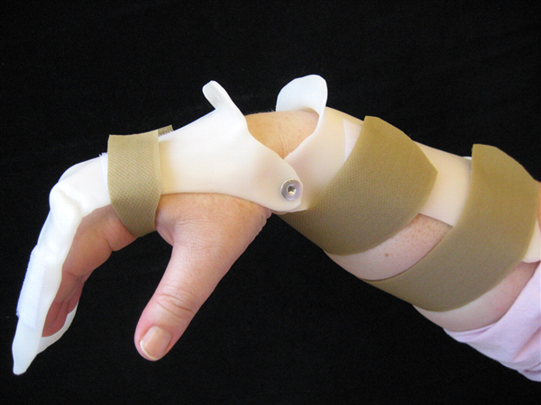 Extensor Tendon Repair Youtube Quadriga Everything You Need To Know